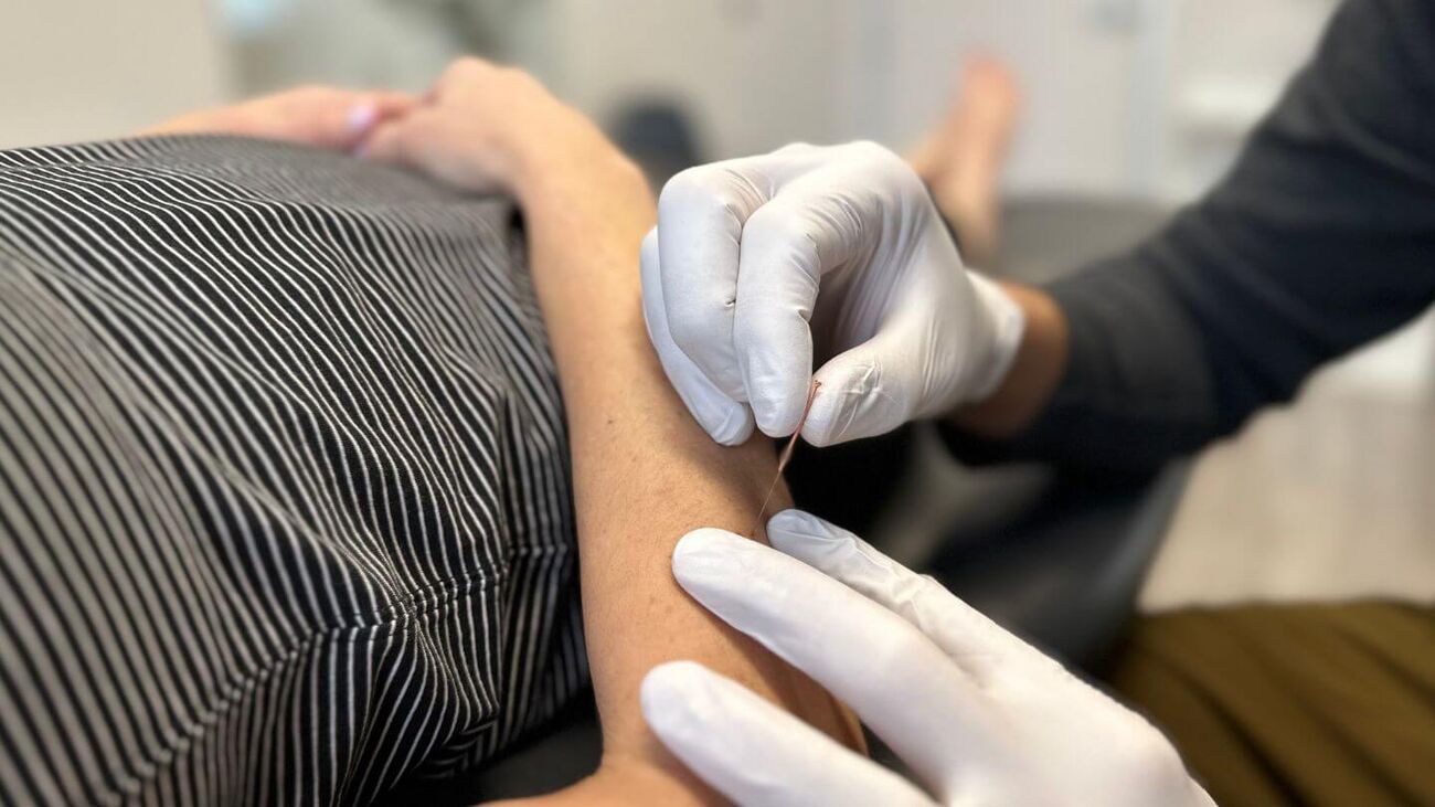 IMS Therapy Dry Needling Downtown Ottawa | MOOV Physiotherapy & Wellness