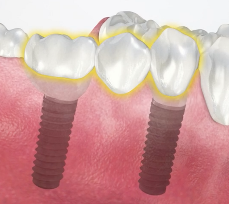 Dental Crowns, Bridges, Inlays, and Onlays | Evergreen Dental Care